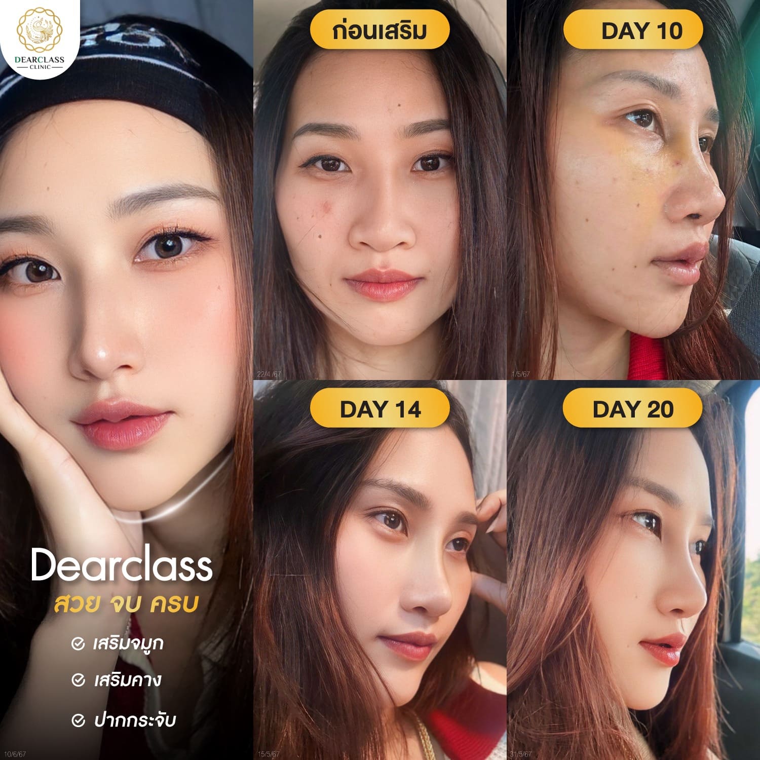 Dearclass Clinic - ศัลยกรรมเสริมคาง Chin Augmentation